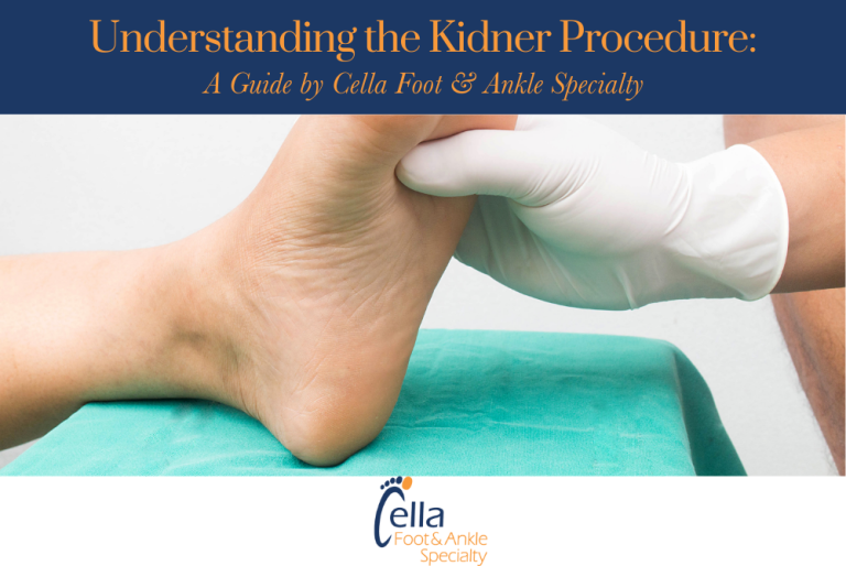 Understanding the Kidner Procedure: A Guide by Cella Foot & Ankle ...