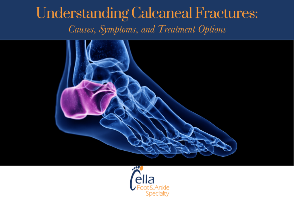 Understanding Calcaneal Fractures: Causes, Symptoms, and Treatment ...