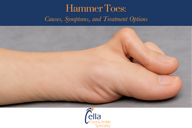 Hammer Toes: Causes, Symptoms, and Treatment Options | Cella Foot ...
